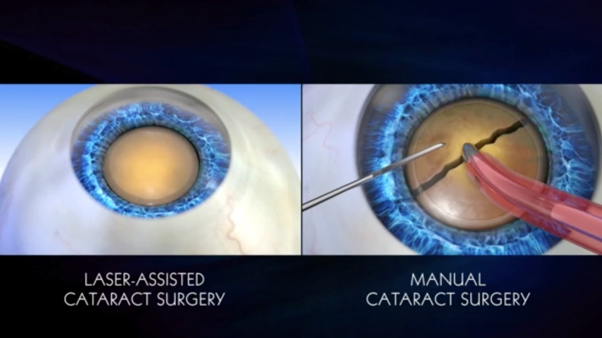 Traditional and Premium Laser Cataract Surgery: Which Should You Choose ...